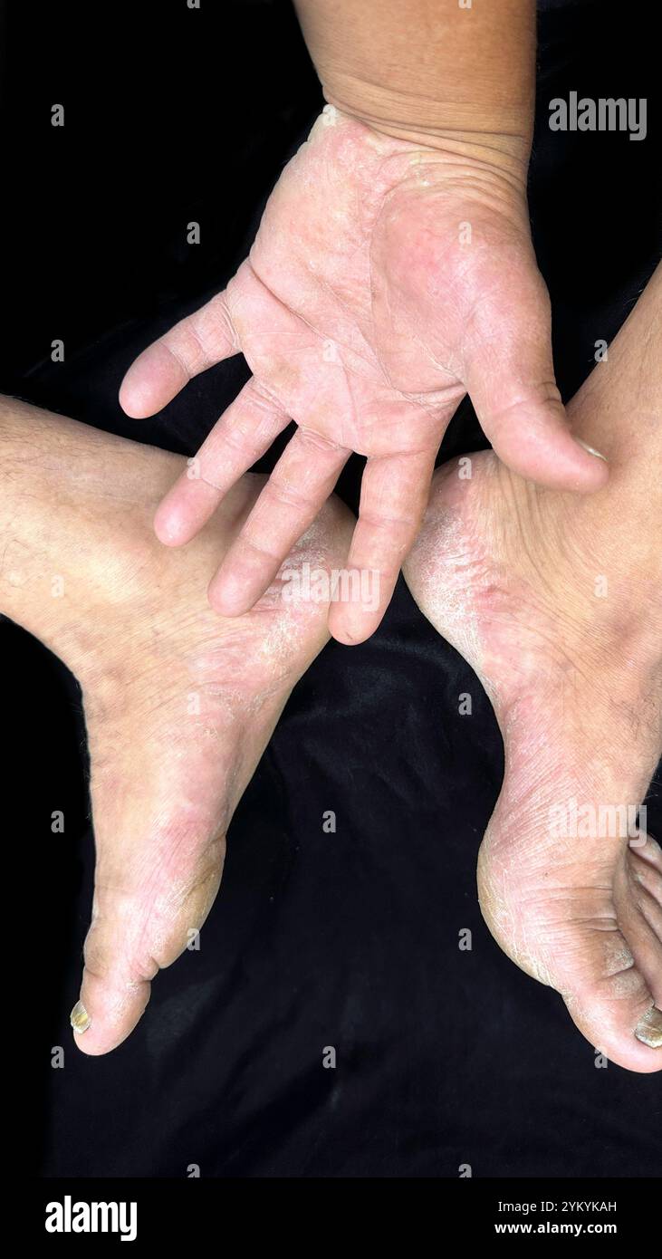 Ringworm infection on both of a patient's feet and one hand. Ringworm ...