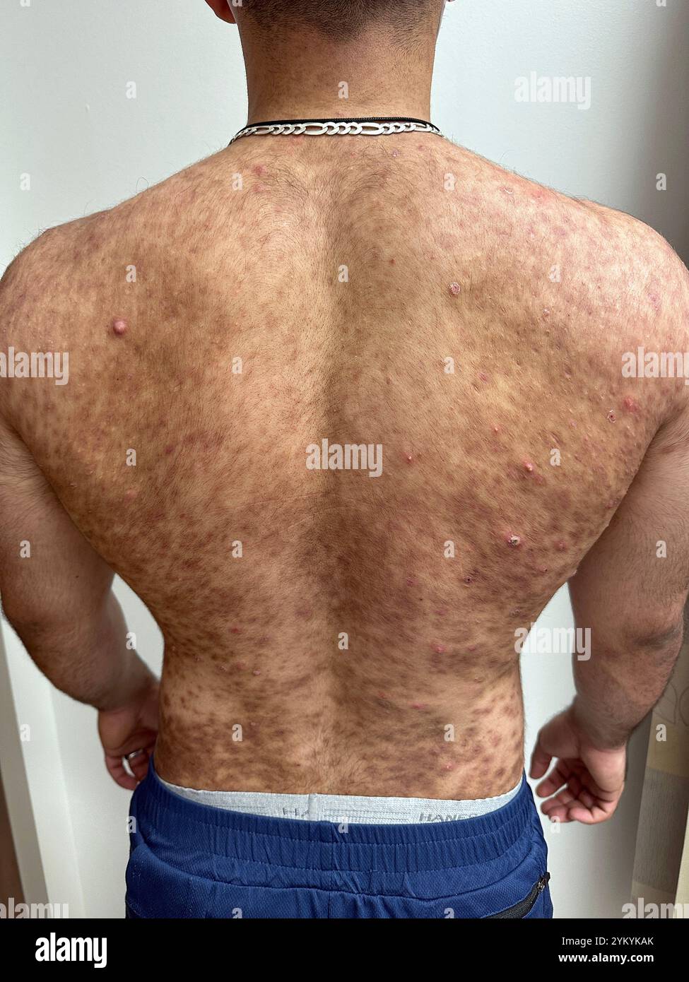 Back of a patient whose acne is improving due to treatment with the ...
