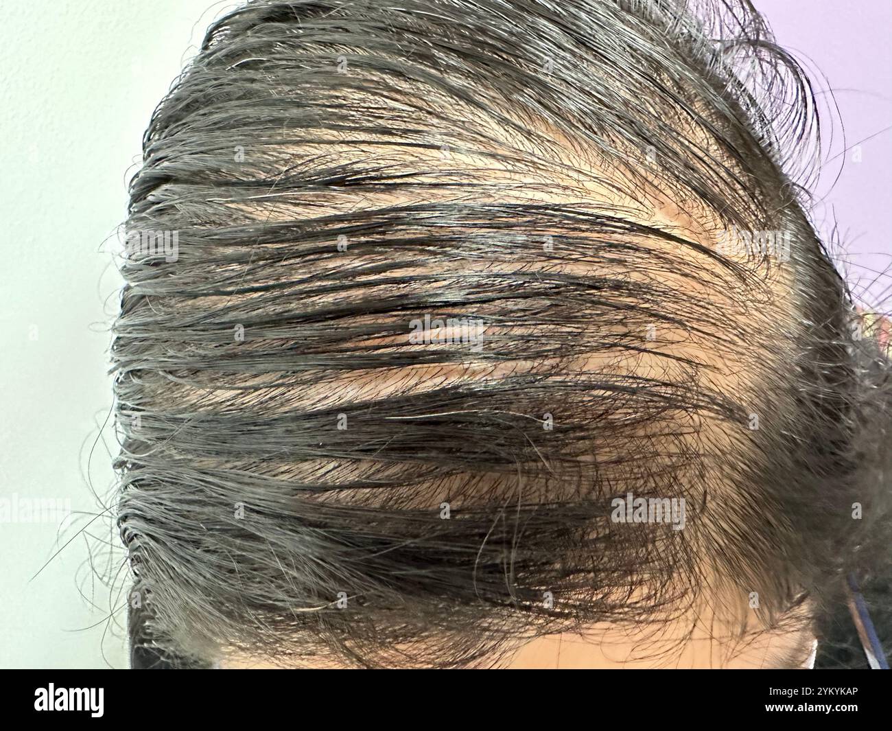 Scalp of a patient with female pattern hair loss, also known as female ...