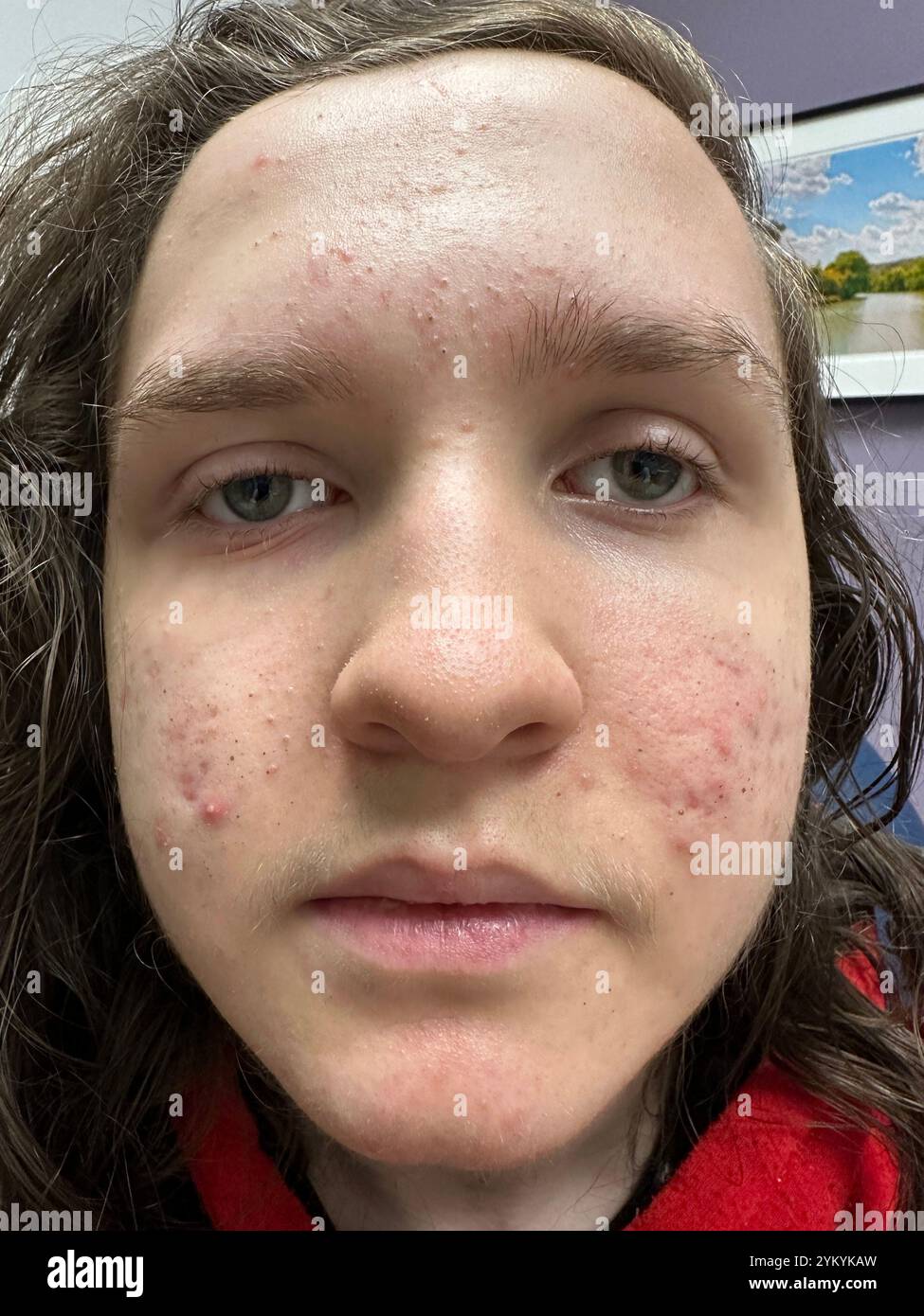 Acne on the face of a 15 year old Hispanic male patient. Acne is a ...