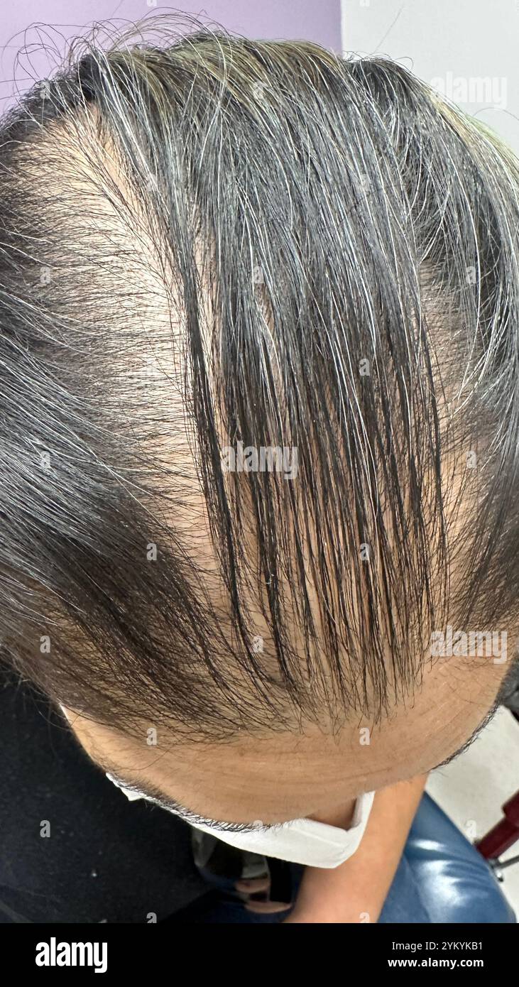 Scalp of a patient with female pattern hair loss, also known as female ...