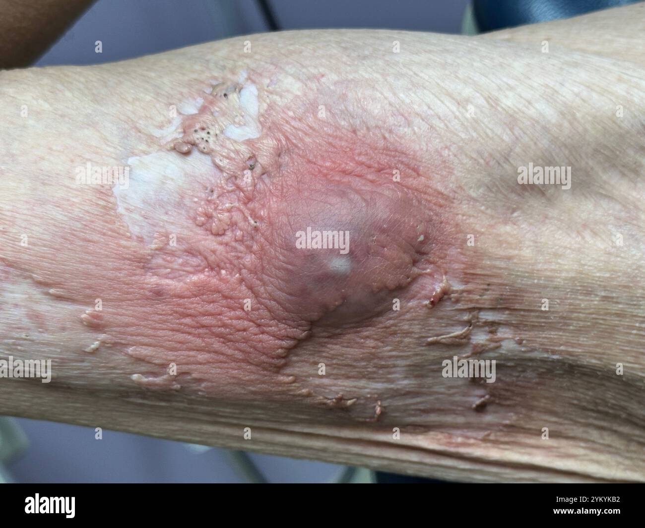 Abscess on the arm of a patient who is being treated with infliximab ...