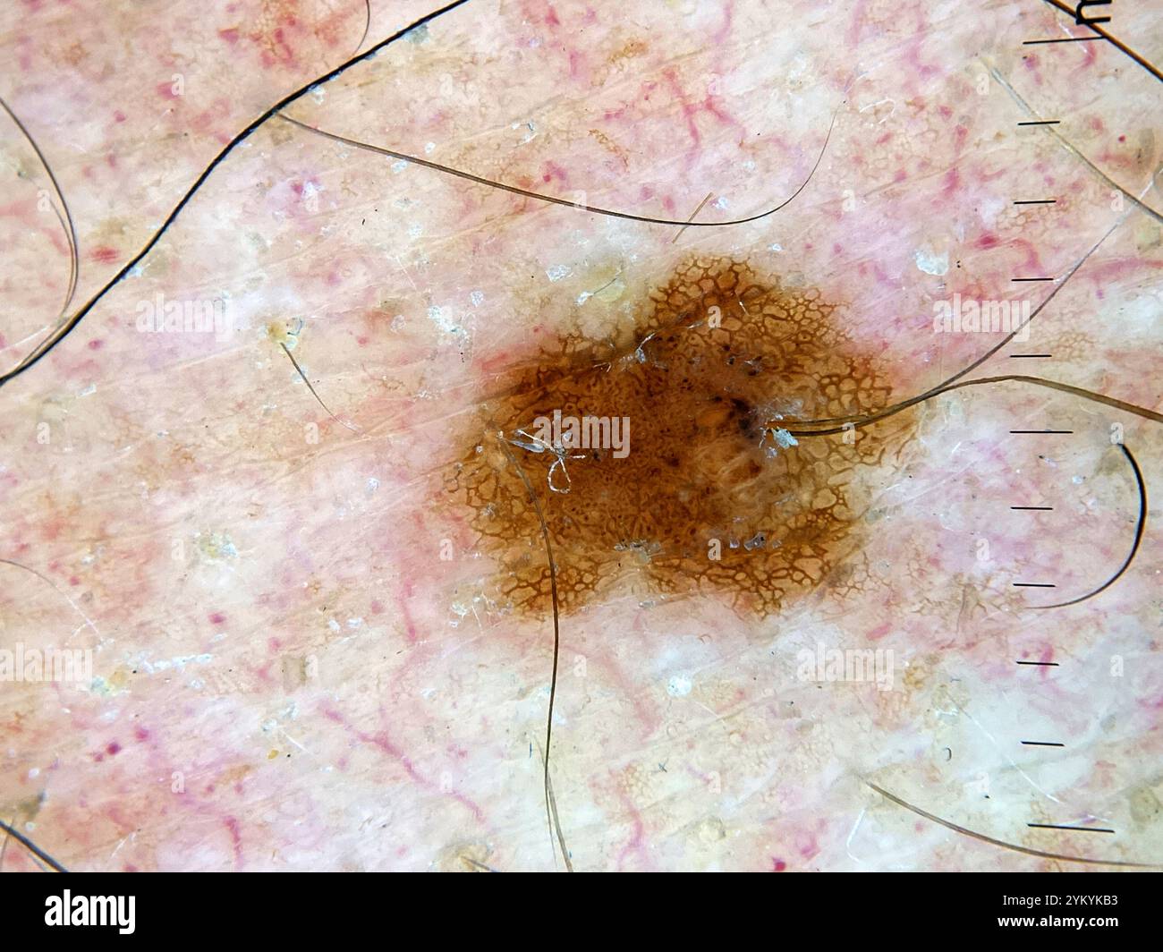 Dermatoscope image of a reticular, or acquired, naevus on a male ...
