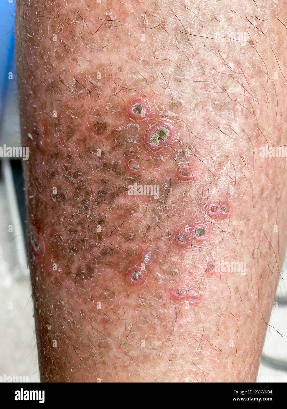 Lesions on the skin of a patient with perforating dermatosis ...