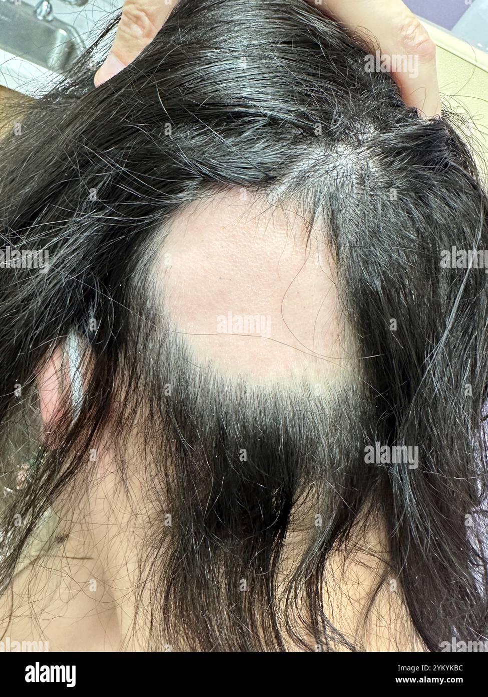 Bald spot on the scalp of a patient with alopecia areata (spot baldness ...