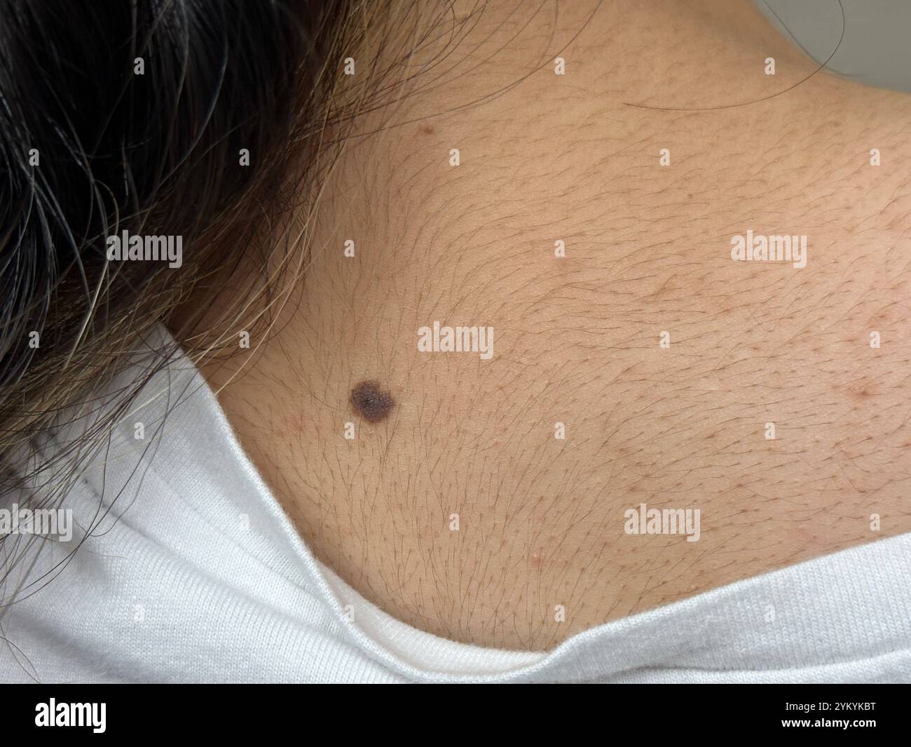 Congenital nevus, or mole, at the base of a 16 year old Hispanic female ...