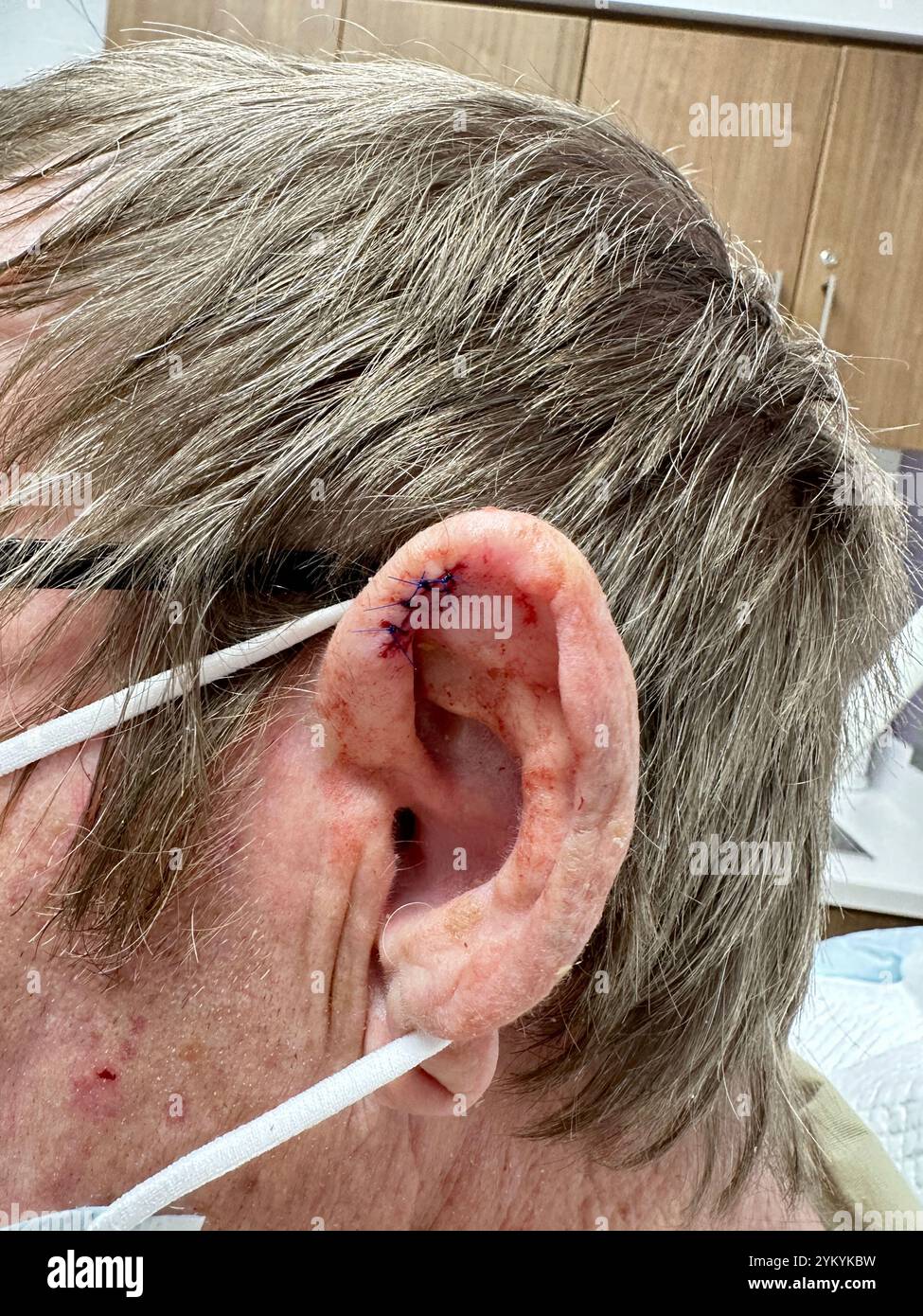 Stitches on the rim of the pinna of the ear of a patient that has had ...
