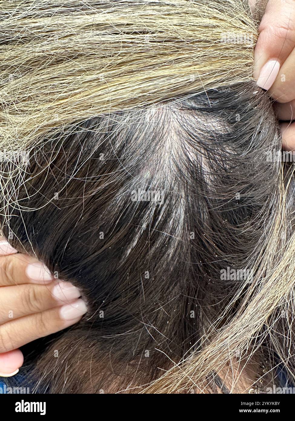 Scalp of a Hispanic patient with female pattern hair loss, also known ...
