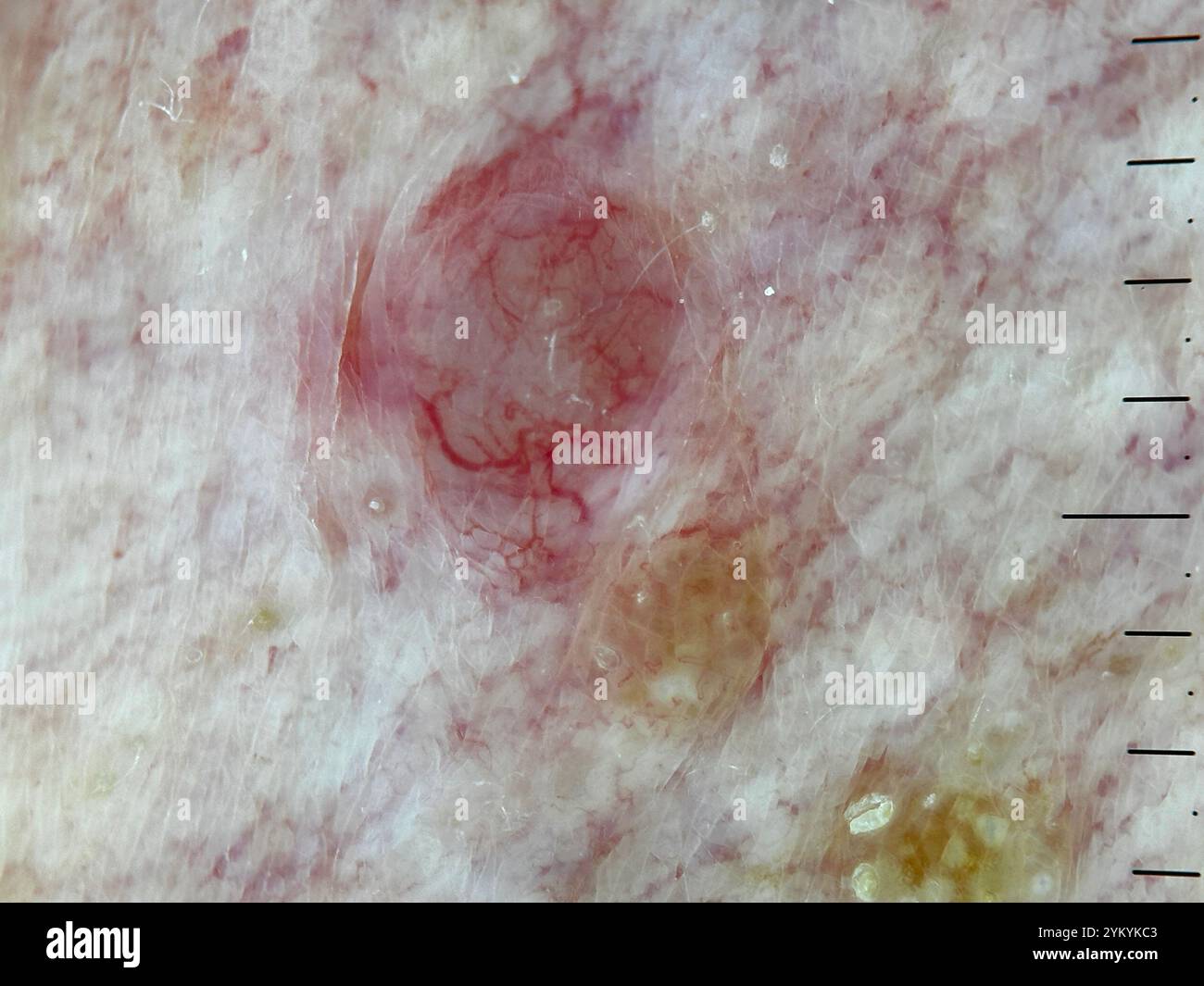 Dermatoscope image of a nodular basal cell carcinoma (BCC), or rodent ...