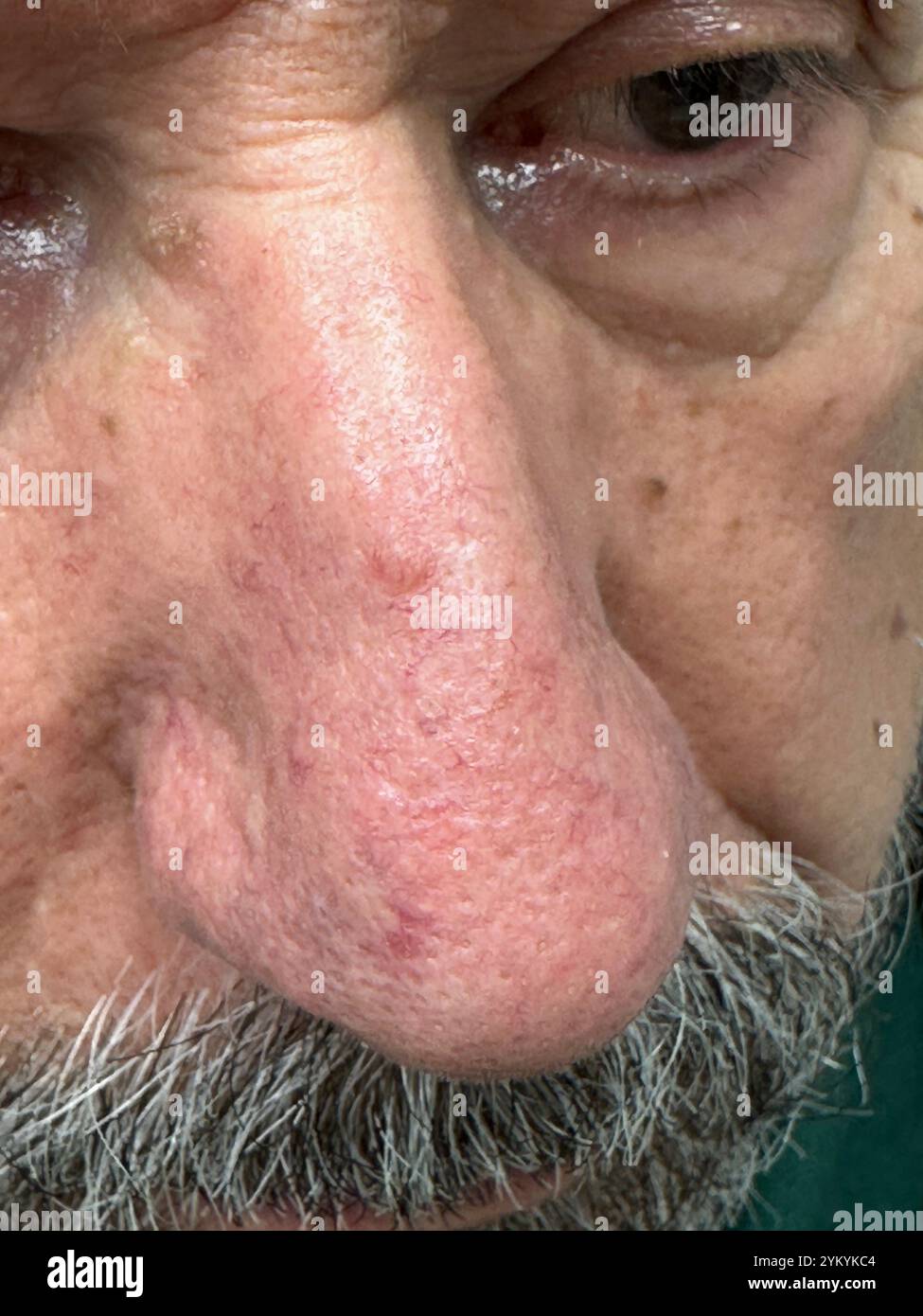 Basal cell carcinoma (BCC), or rodent ulcer, on a patient's nose. This ...