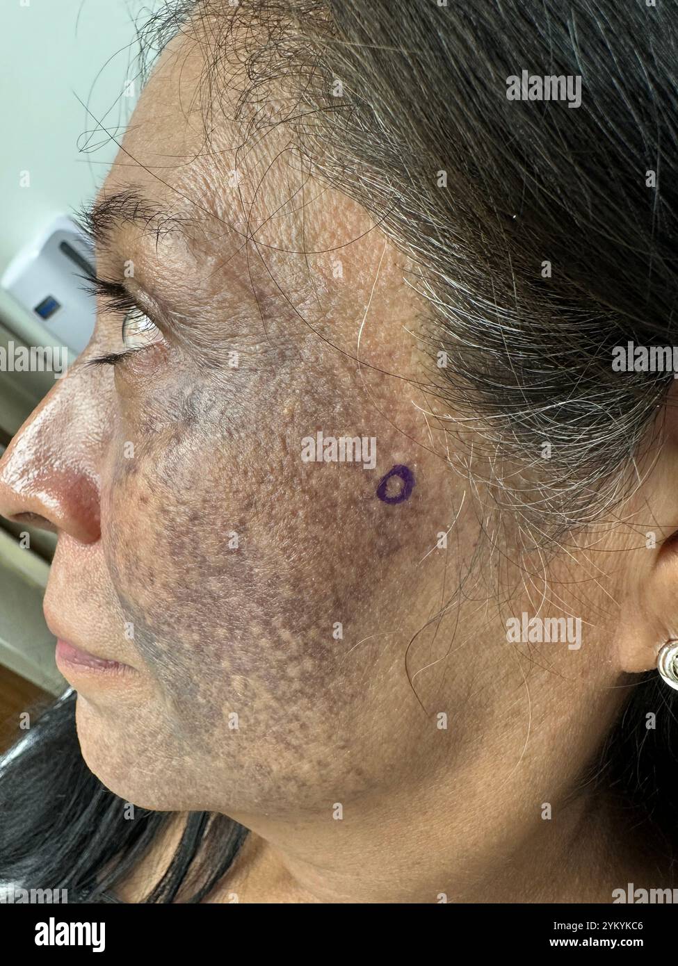 Ashy dermatosis on a patient's face. This condition, also known as ...