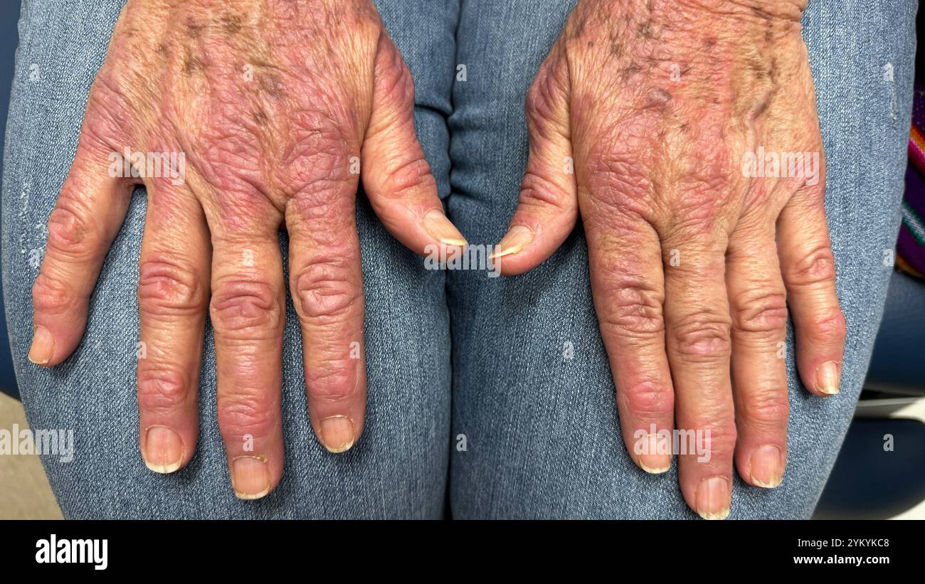 Rash on the hands of a patient with dermatomyositis. Dermatomyositis is ...