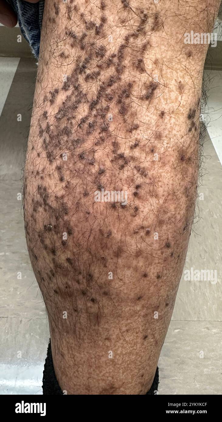 Leg of a Hispanic male patient with Darier's disease (keratosis ...