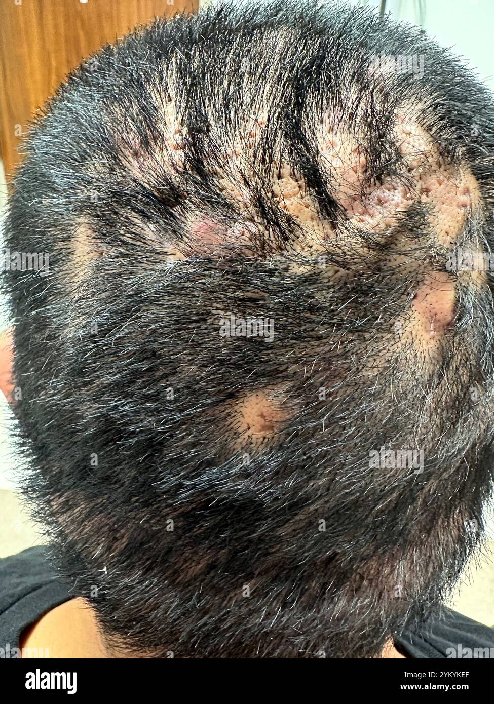 Scarring and alopecia on the scalp of a Hispanic male patient with ...