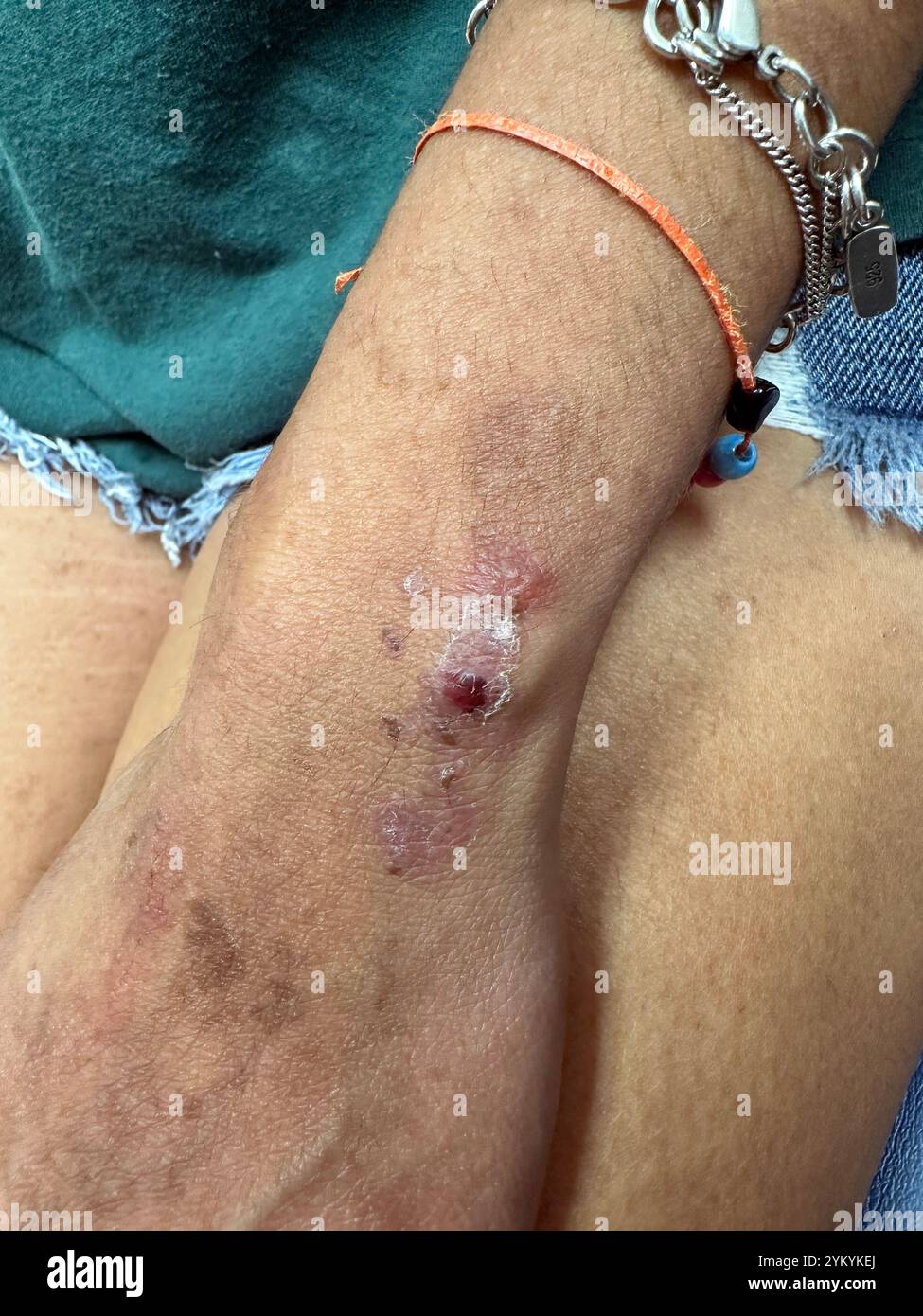 Epidermolysis bullosa (EB) blisters on the wrist of a Hispanic female ...