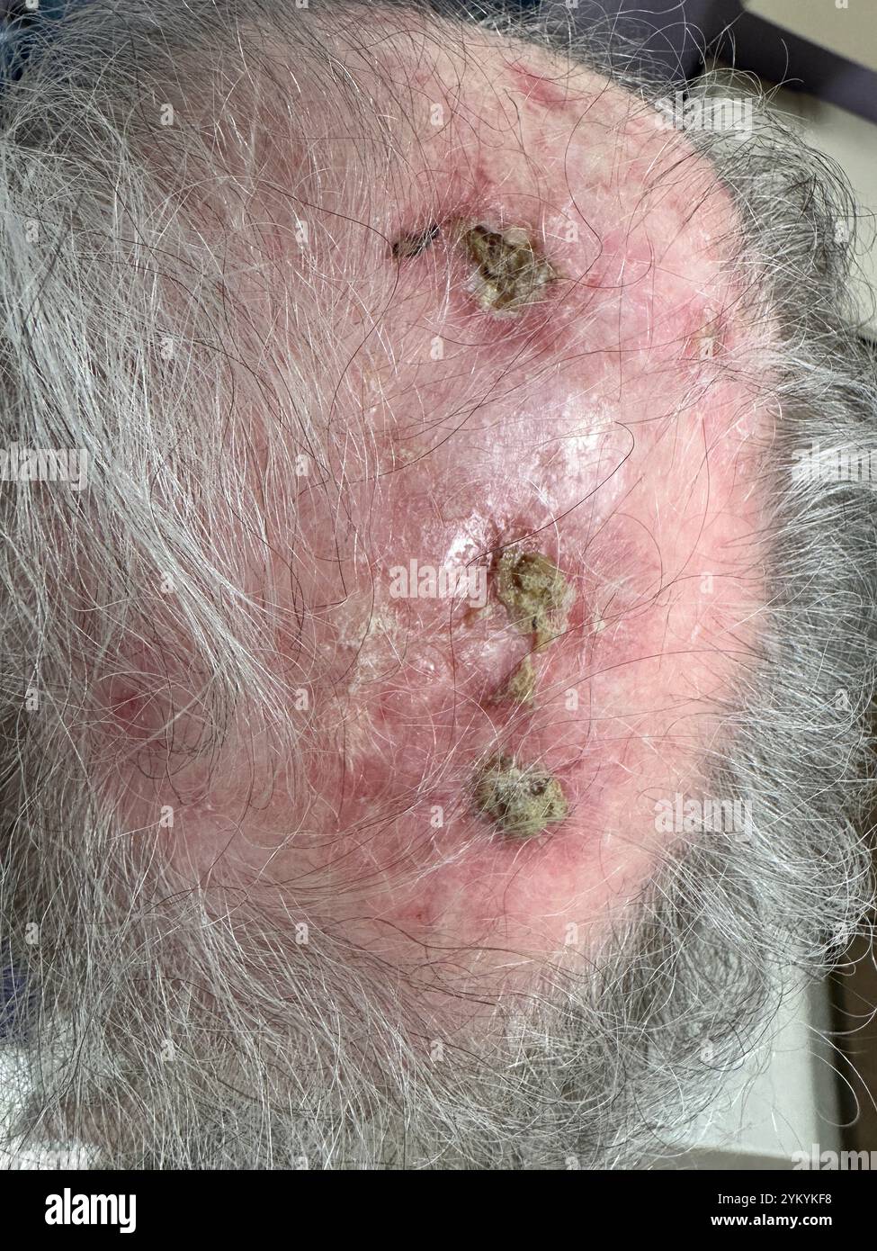 Top of the head of a patient with erosive pustular dermatosis of the ...