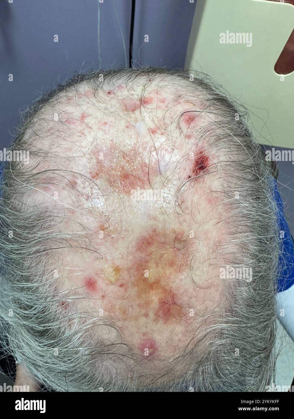 Top of the head of a patient with erosive pustular dermatosis of the ...
