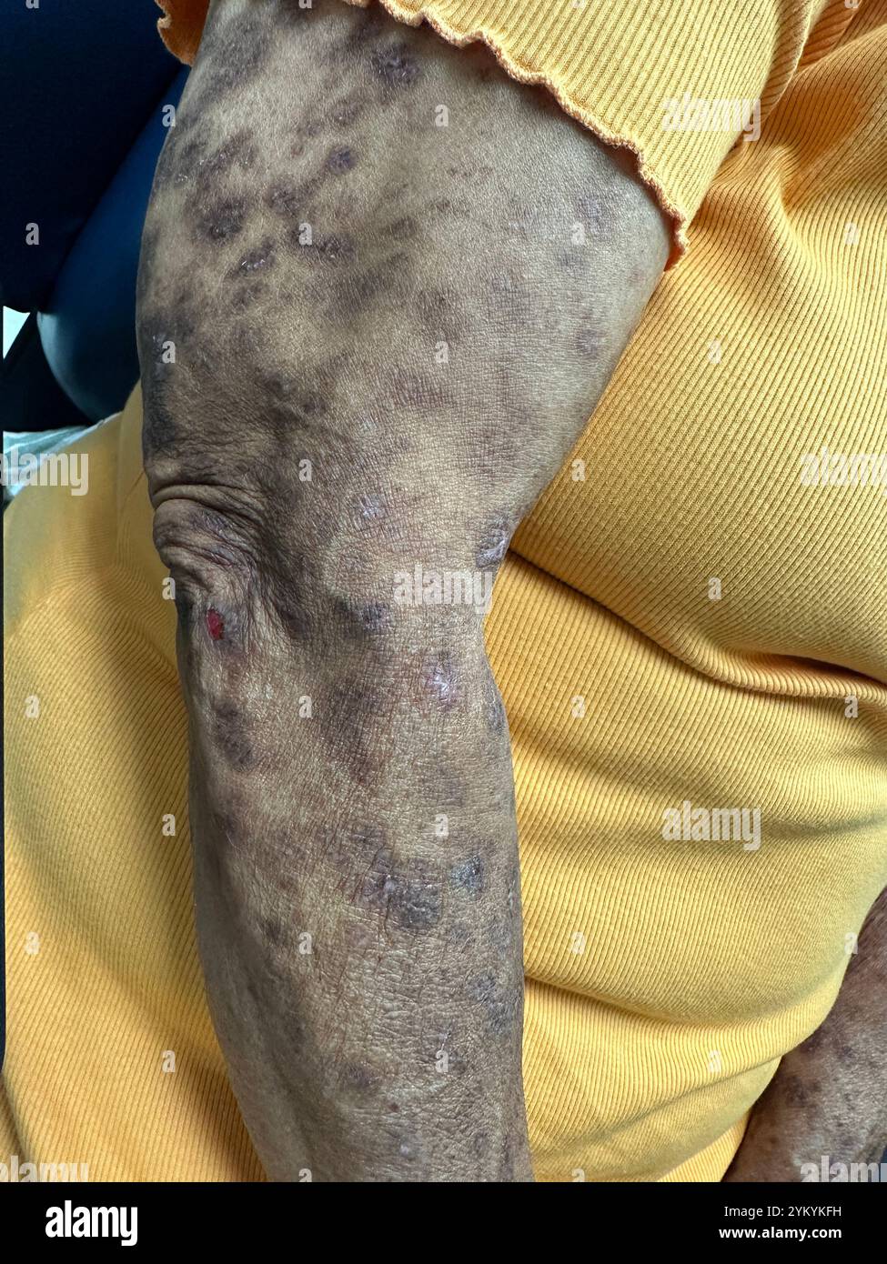 Bullous pemphigoid improving with treatment Stock Photo - Alamy