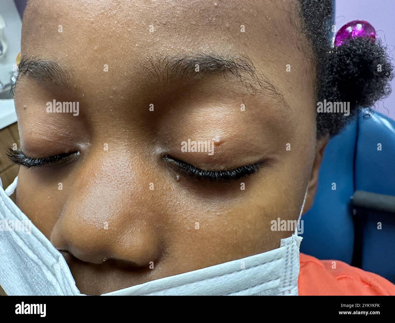 Papules on the face of an African-American girl with molluscum ...