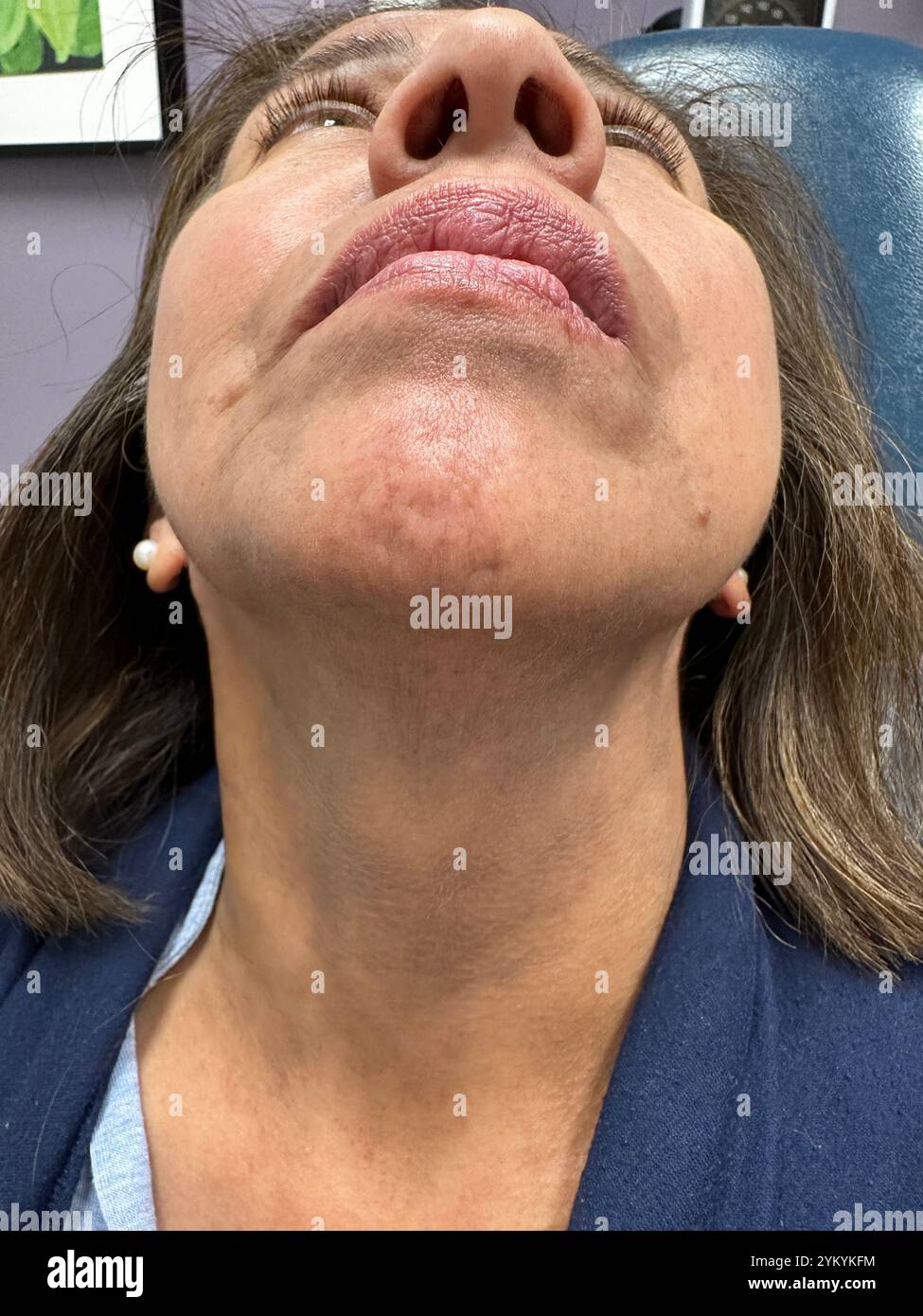 Ashy dermatosis on a patient's face that is improving with the use of ...