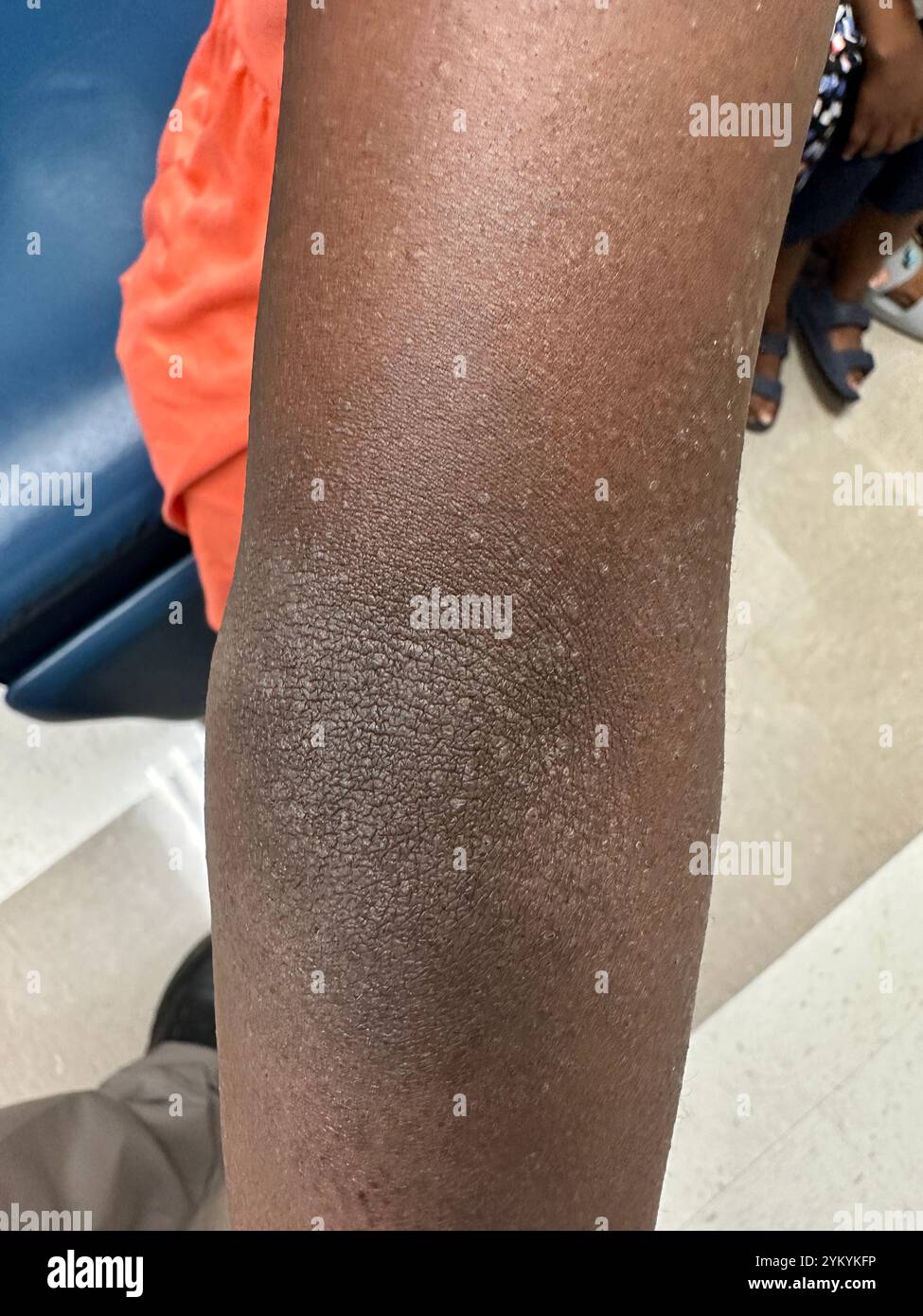 Papules and dry skin on the arm of an African-American girl with ...