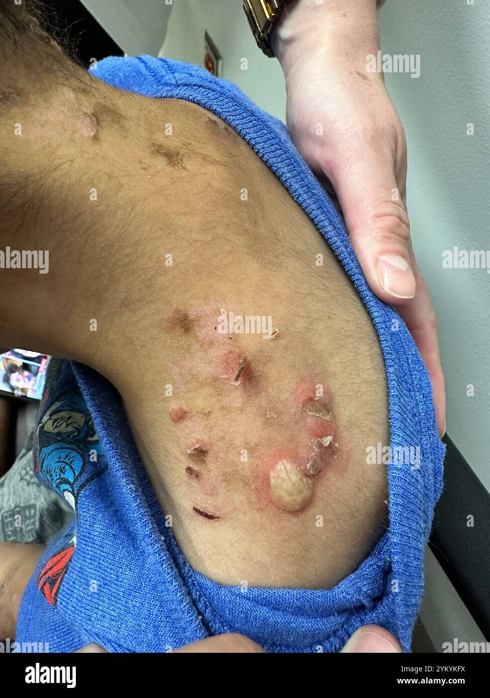 Epidermolysis bullosa simplex (EBS) blisters on the shoulder of a 6 ...