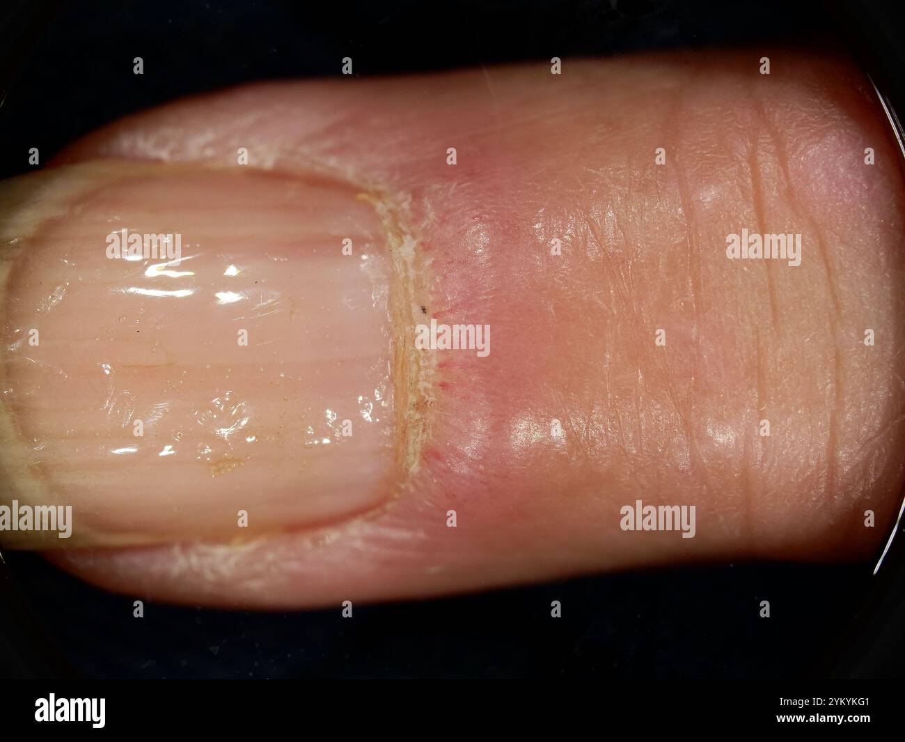 Finger of a patient with dermatomyositis of the cuticle ...