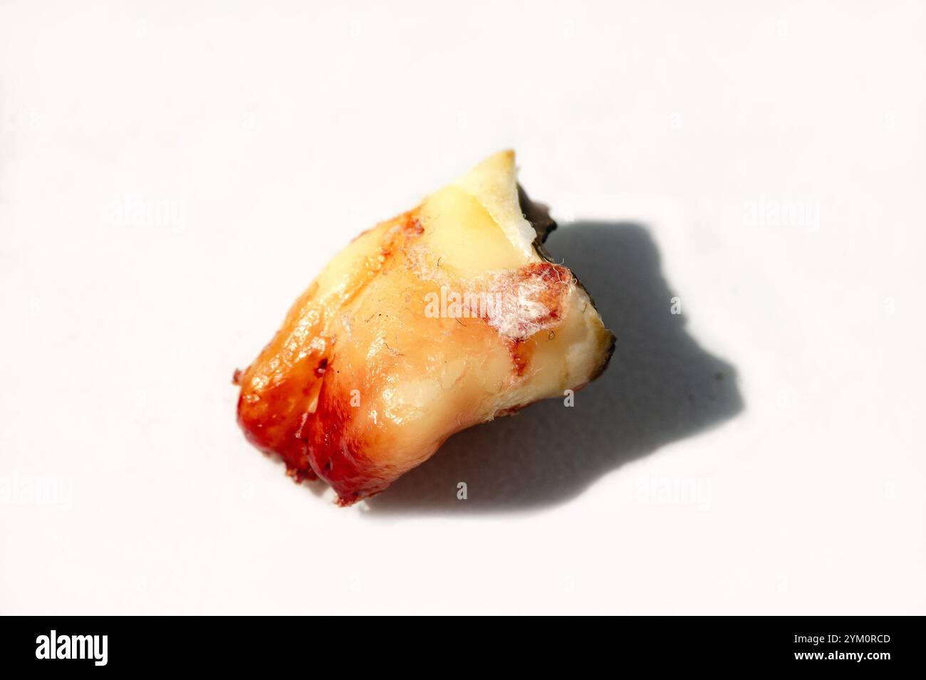 Tooth decay close up hi-res stock photography and images - Alamy