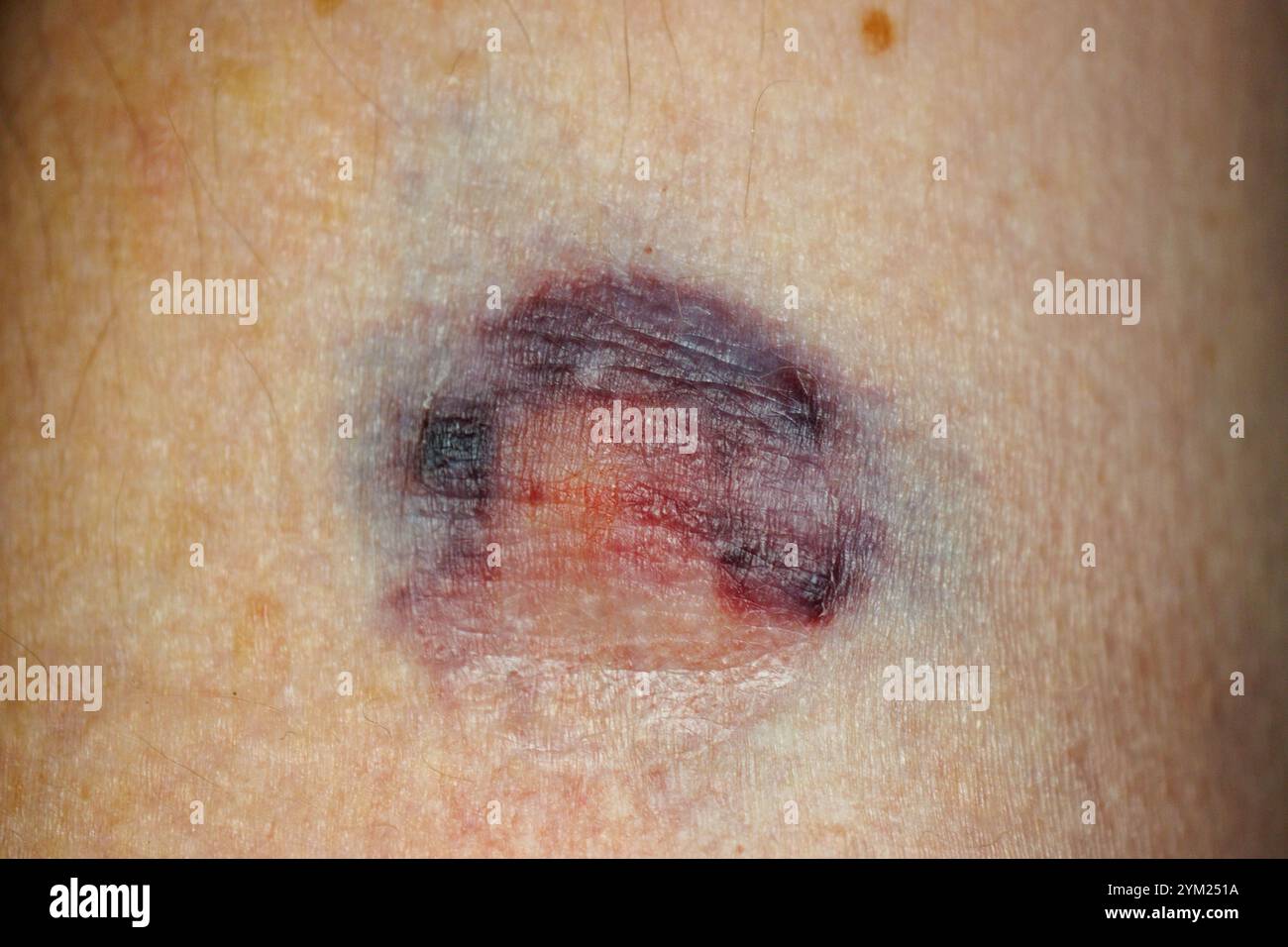 Blood Test with bruising Stock Photo - Alamy