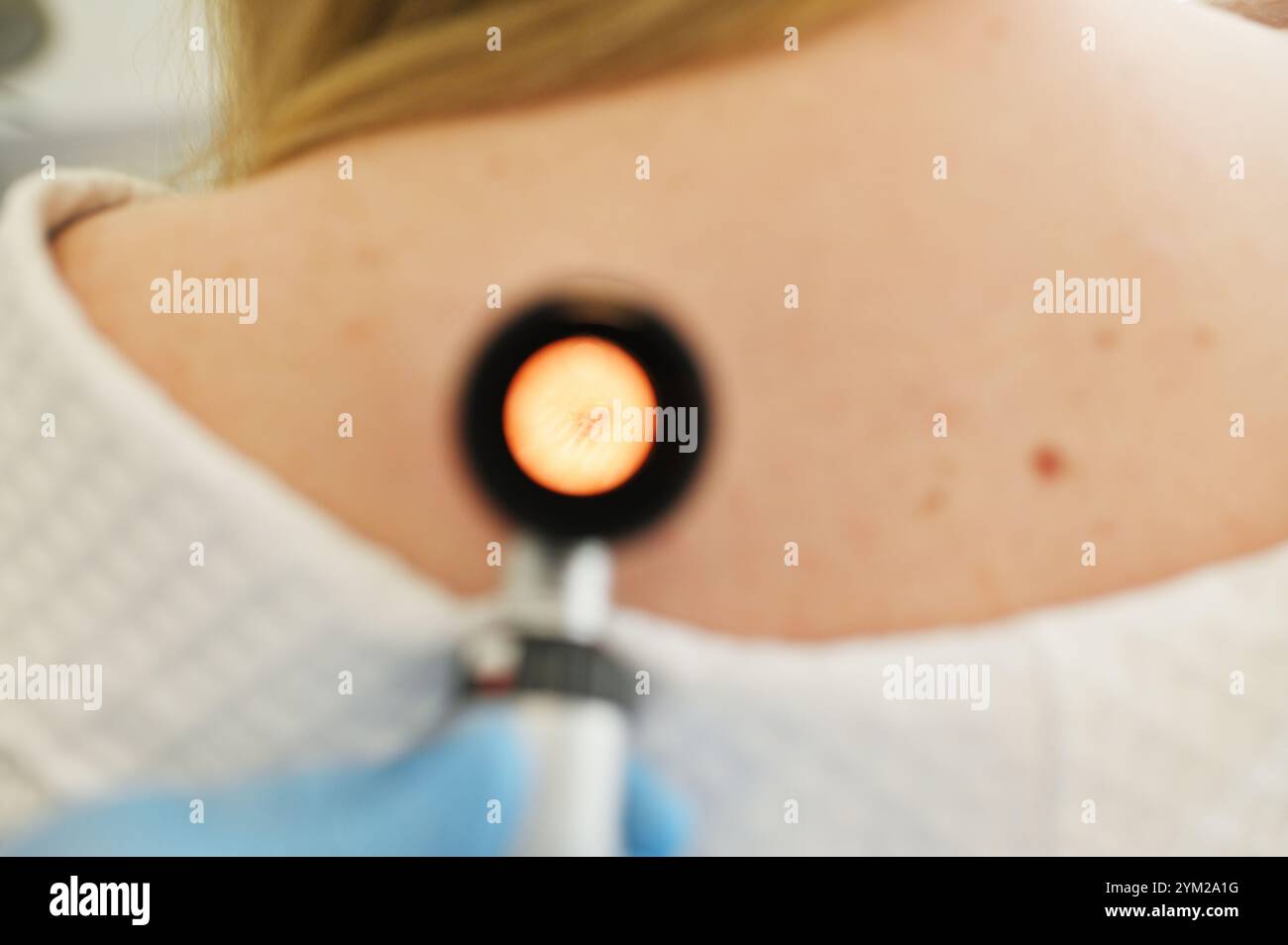 a dermatologist examines moles and skin growths on the patient's body ...
