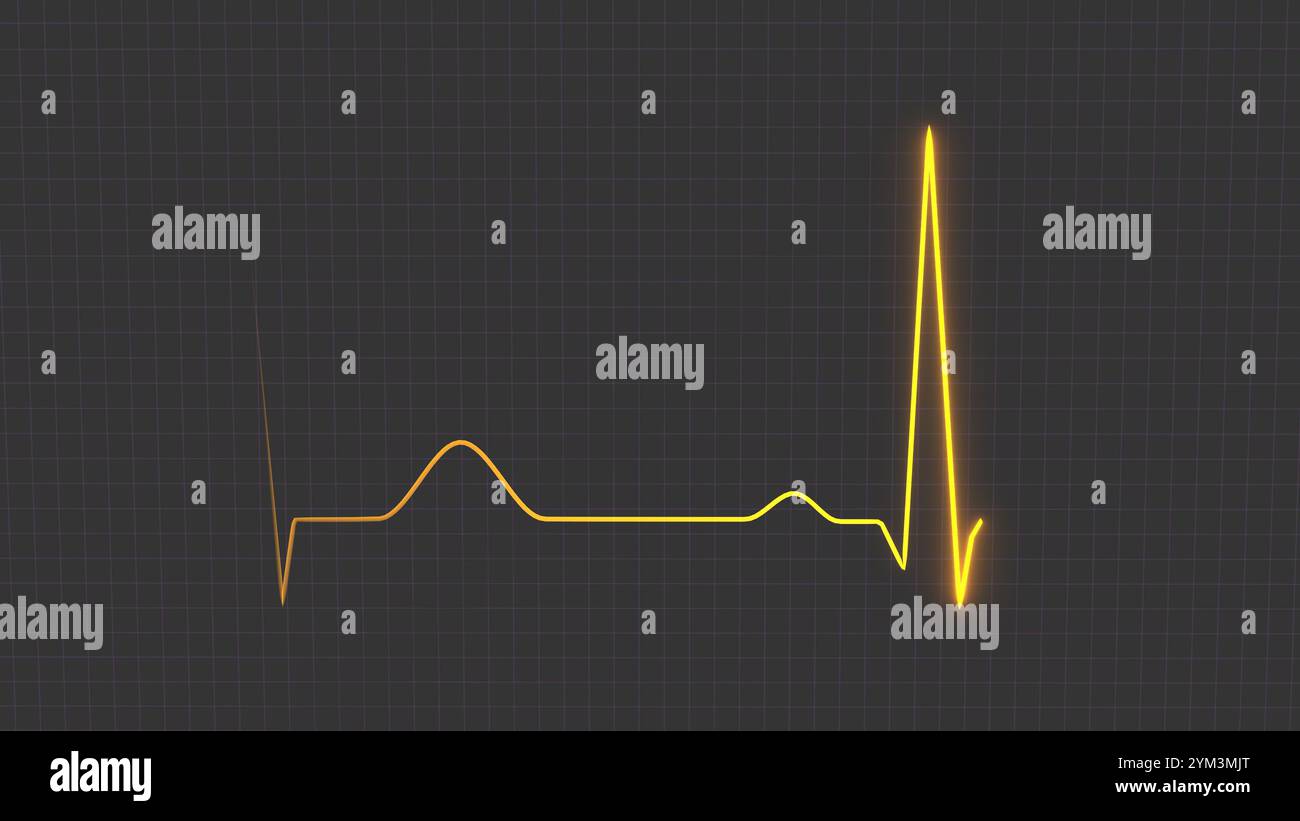 Normal heart rhythm ECG electrocardiogram of a healthy person, heart ...