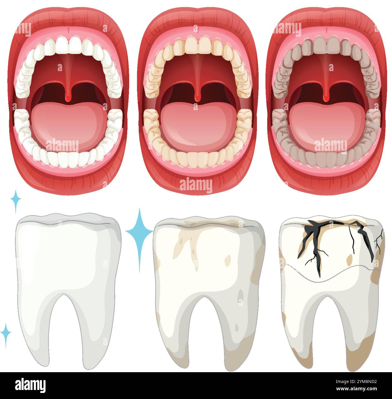 Illustration of healthy and decayed teeth stages Stock Vector Image ...