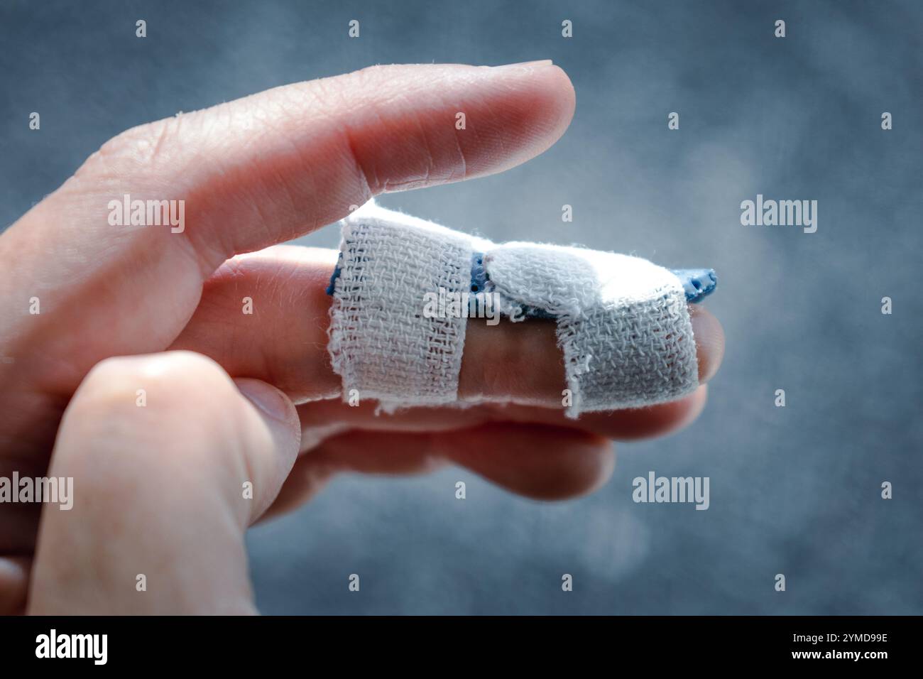 Mallet finger with custom orthosis on the middle finger to immobilize ...