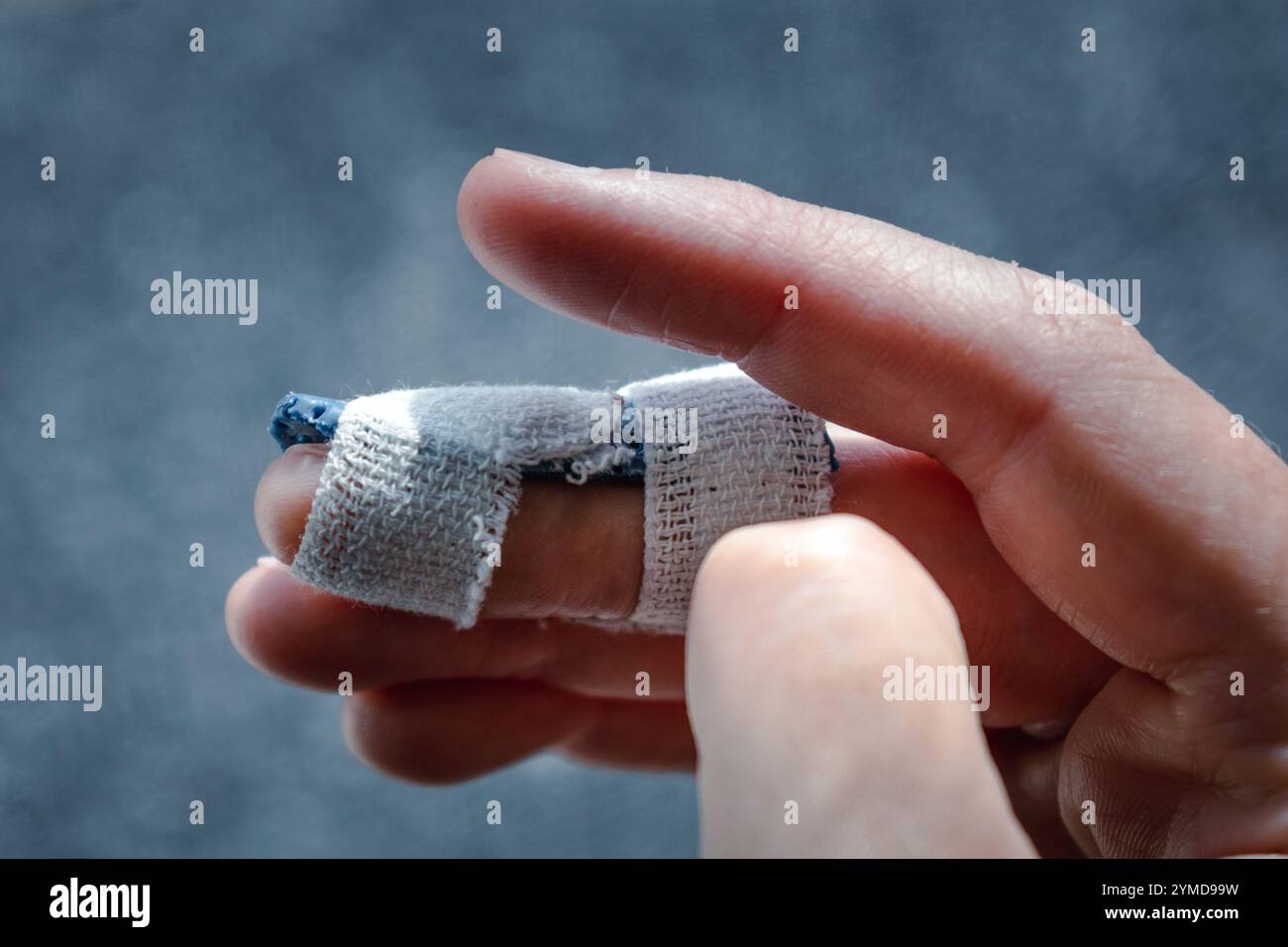 Mallet finger with custom orthosis on the middle finger to immobilize ...