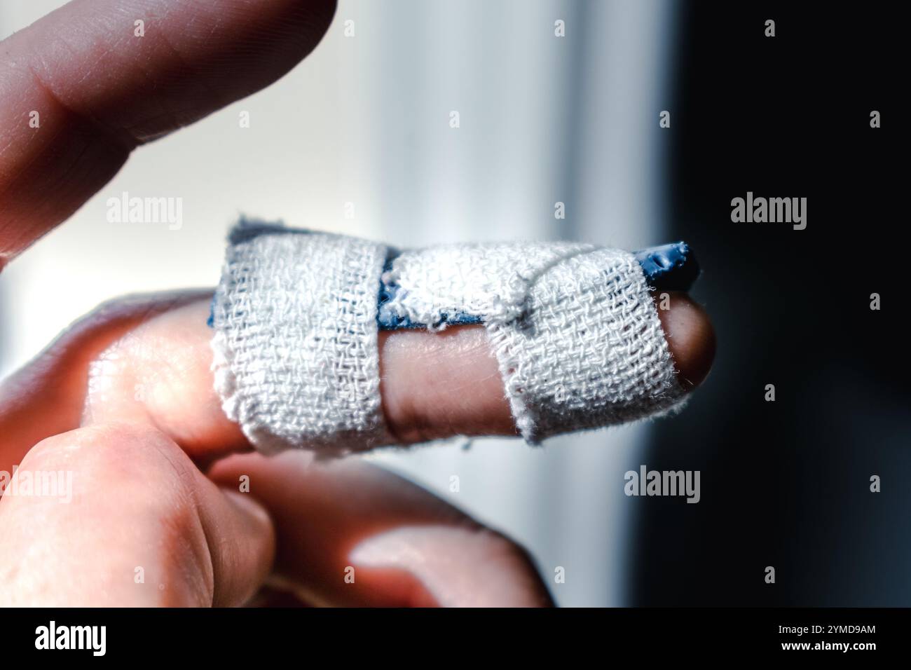 Mallet finger with custom orthosis on the middle finger to immobilize ...