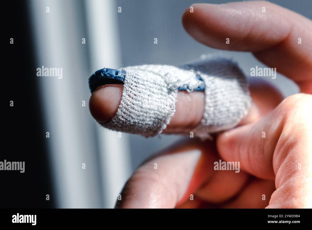 Mallet finger with custom orthosis on the middle finger to immobilize ...