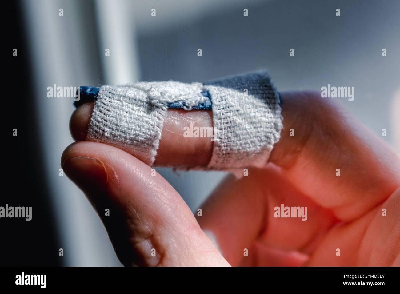 Mallet finger with custom orthosis on the middle finger to immobilize ...