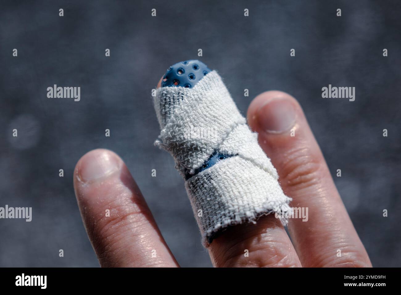 Mallet finger with custom orthosis on the middle finger to immobilize ...