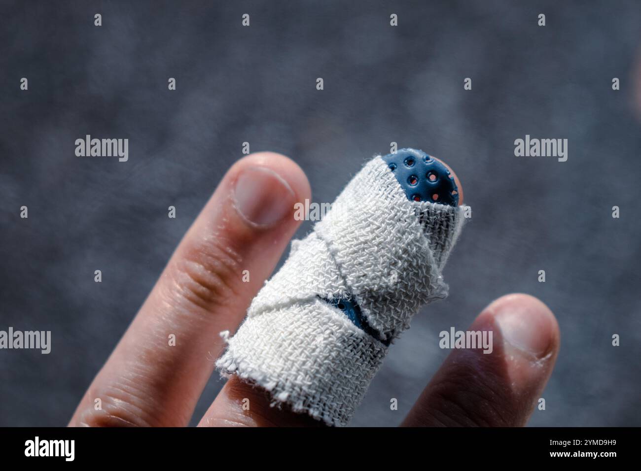Mallet finger with custom orthosis on the middle finger to immobilize ...