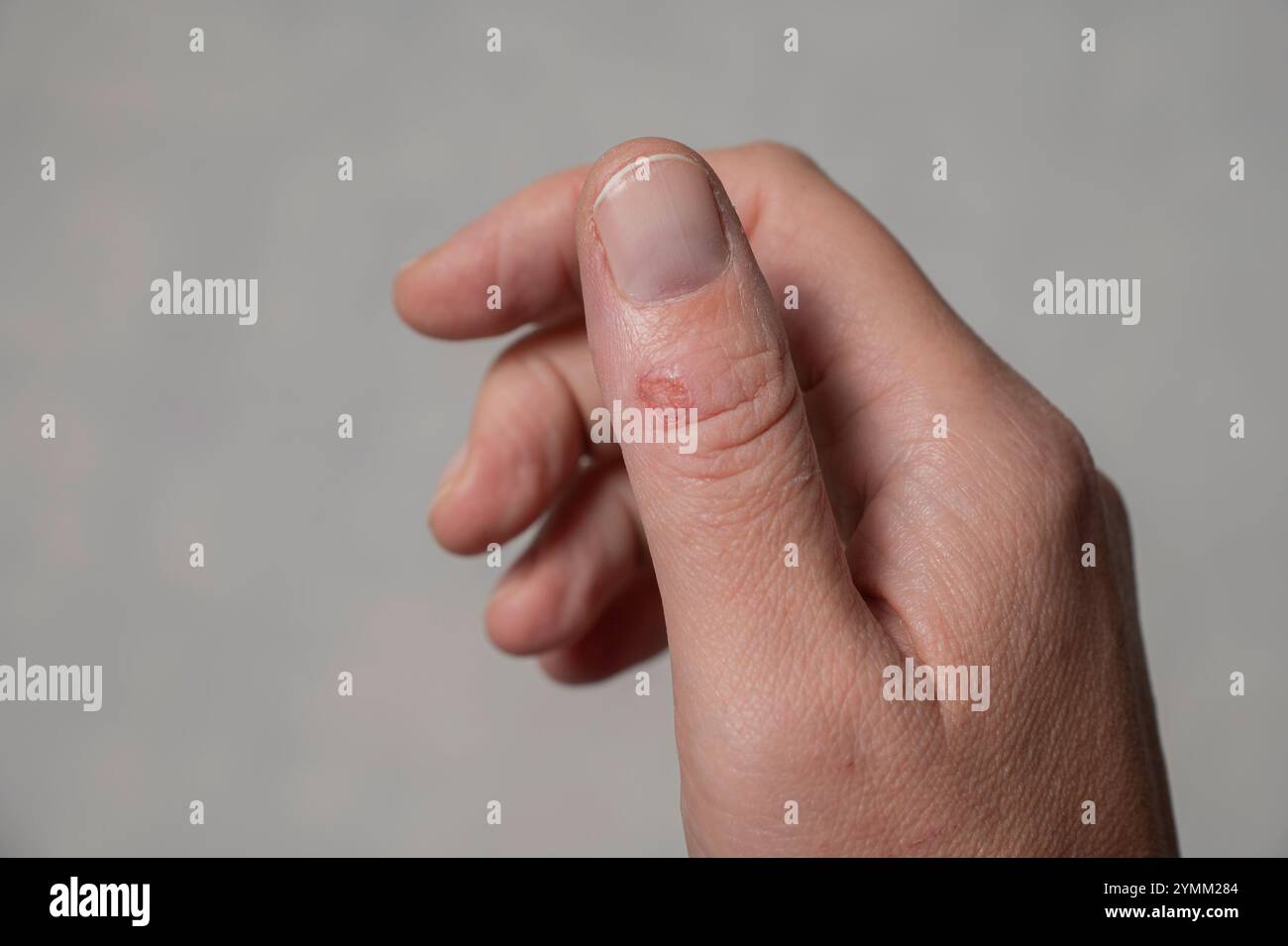 Cat bite wound hi-res stock photography and images - Alamy