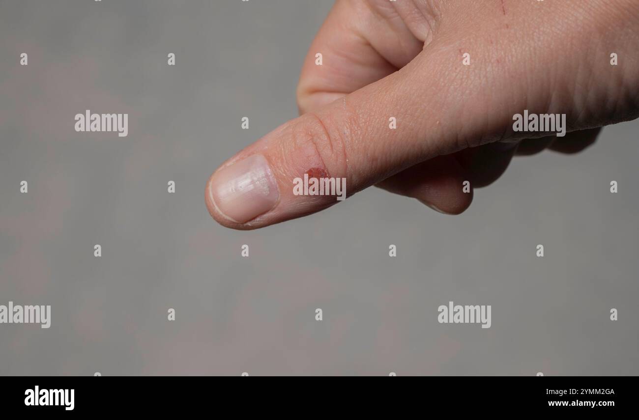 Blood wound finger nail hi-res stock photography and images - Alamy