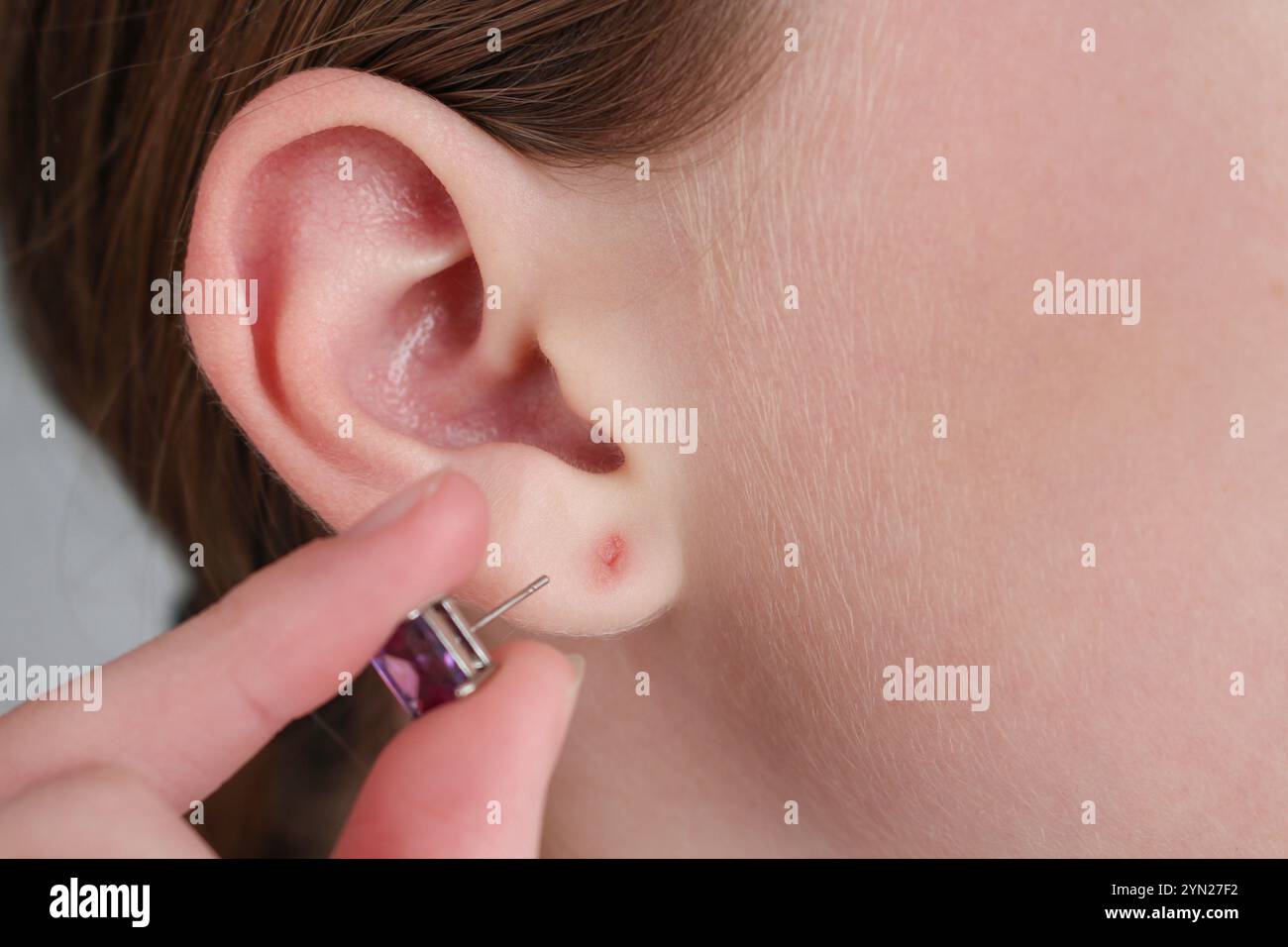 The teenager tore off his earlobe with an earring. The wound on the ear ...