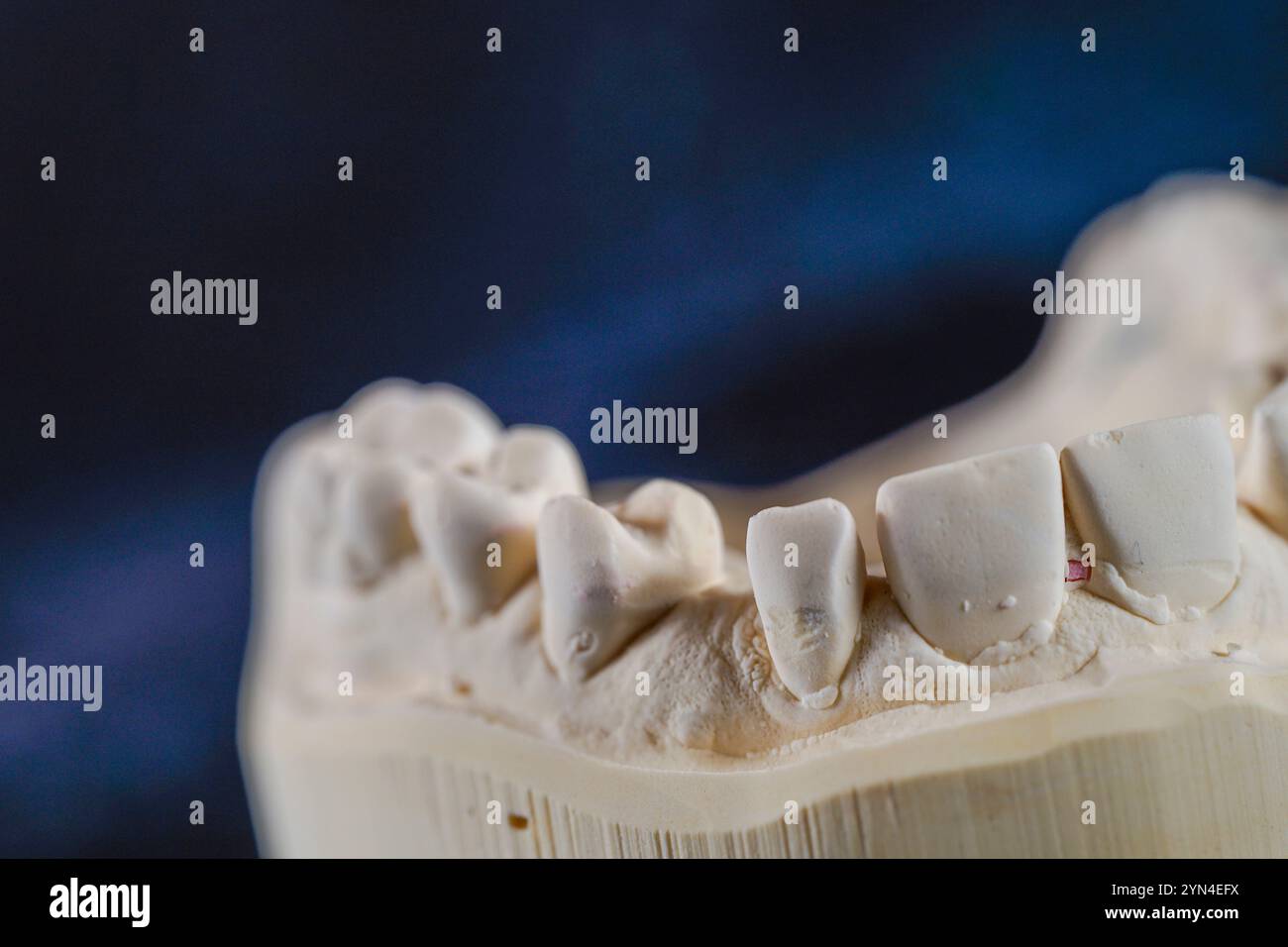 Protesis dental hi-res stock photography and images - Alamy