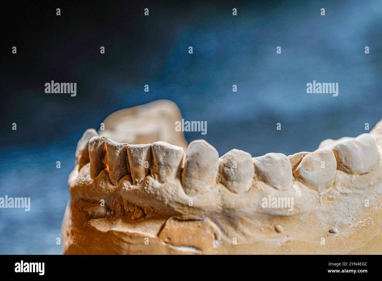 Protesis dental hi-res stock photography and images - Alamy