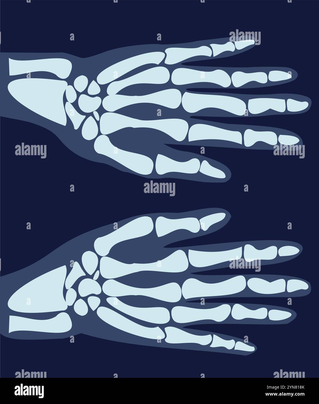 X rays image with bone. Xray of hand and arm. Diagnosis and treatment ...