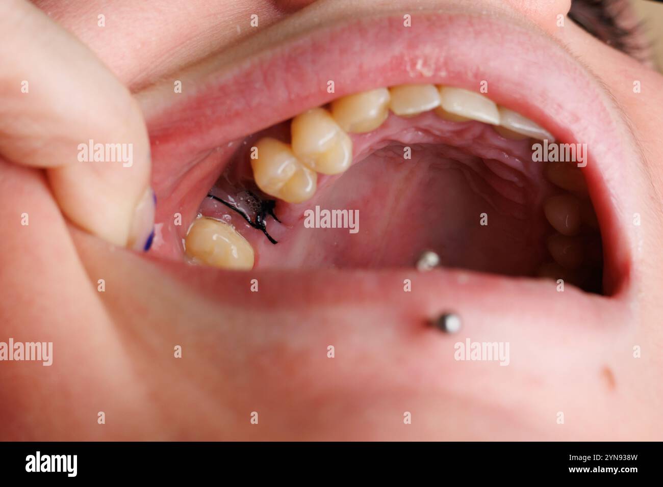 Close-up of open mouth with dental stitch Stock Photo - Alamy