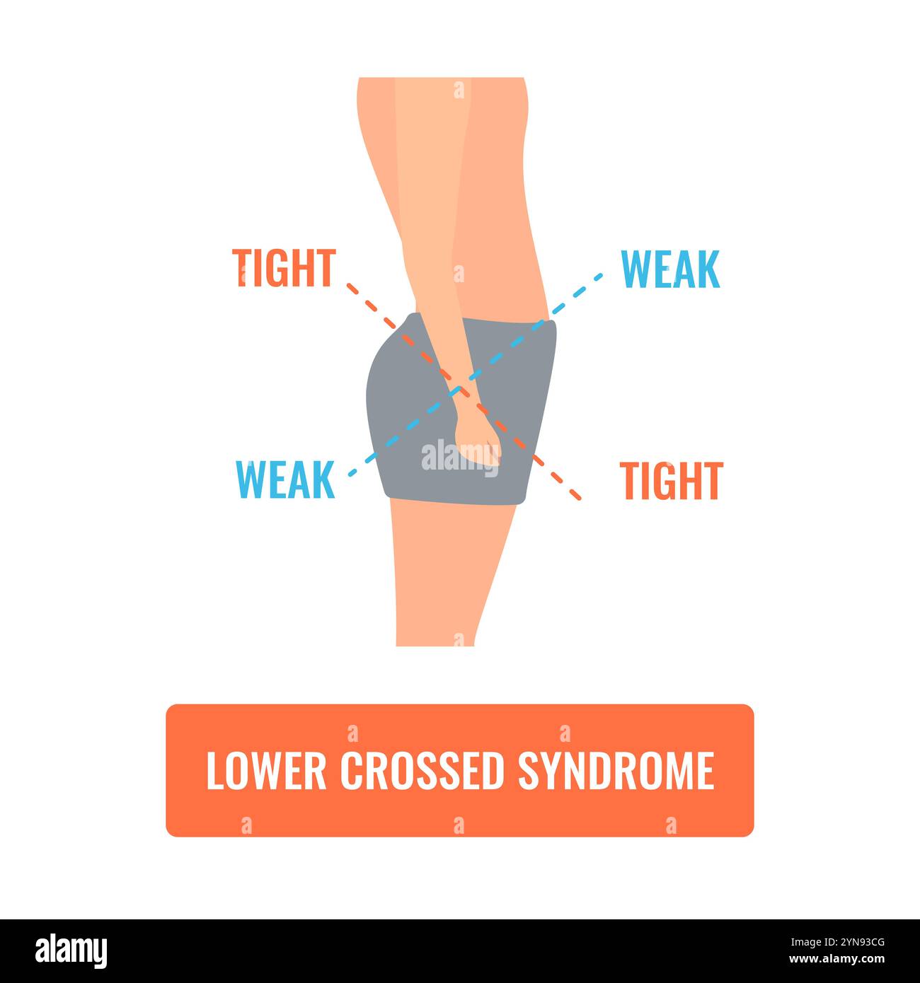 Lower crossed syndrome Stock Vector Images - Alamy