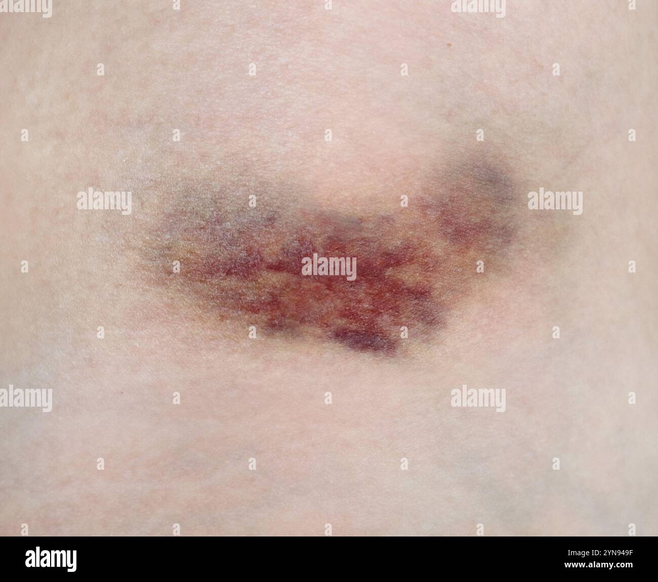 Close up purple bruise on skin. Bruise from impact. Bruising and ...