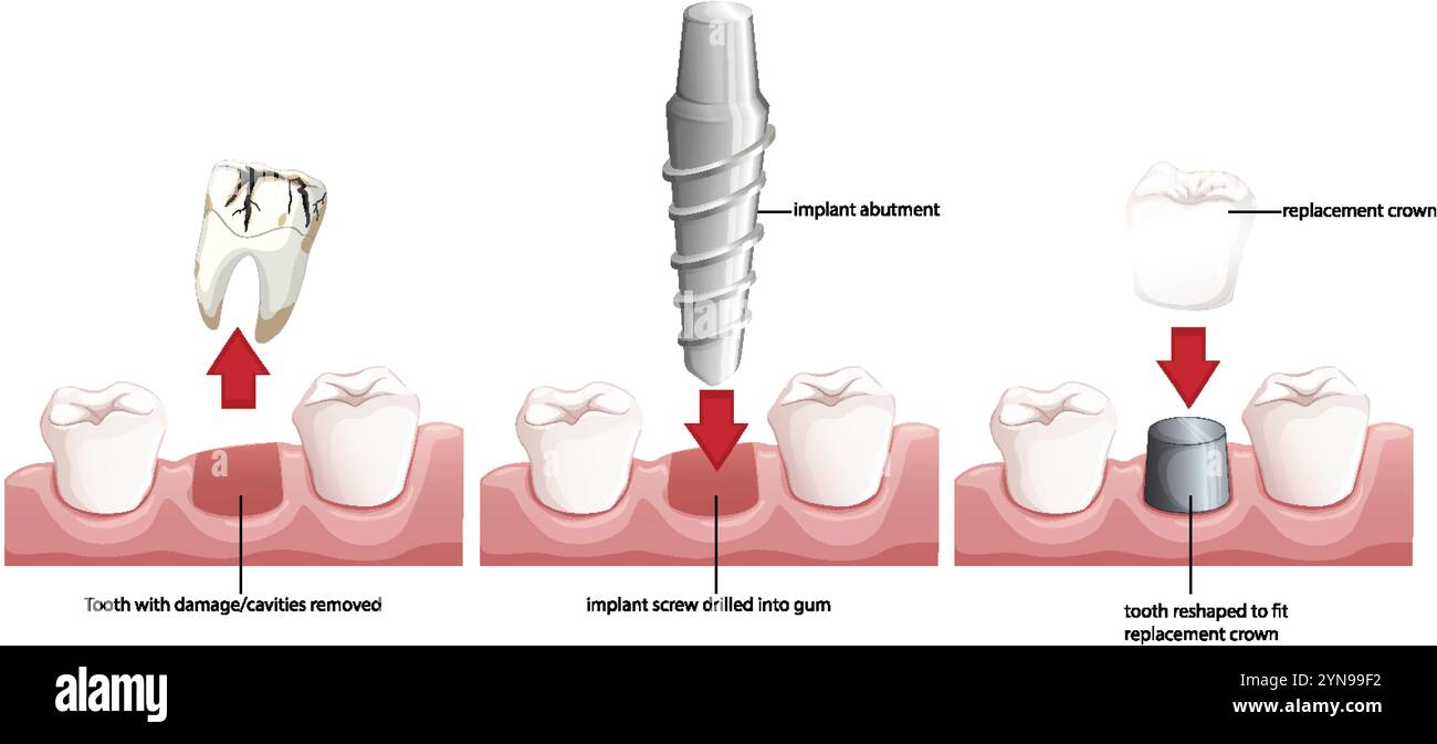 Step-by-step guide to dental implant process Stock Vector Image & Art ...