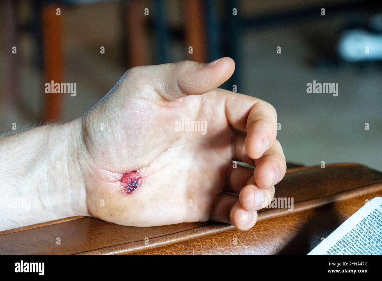 Hand with visible injury, showing healing process in indoor setting ...